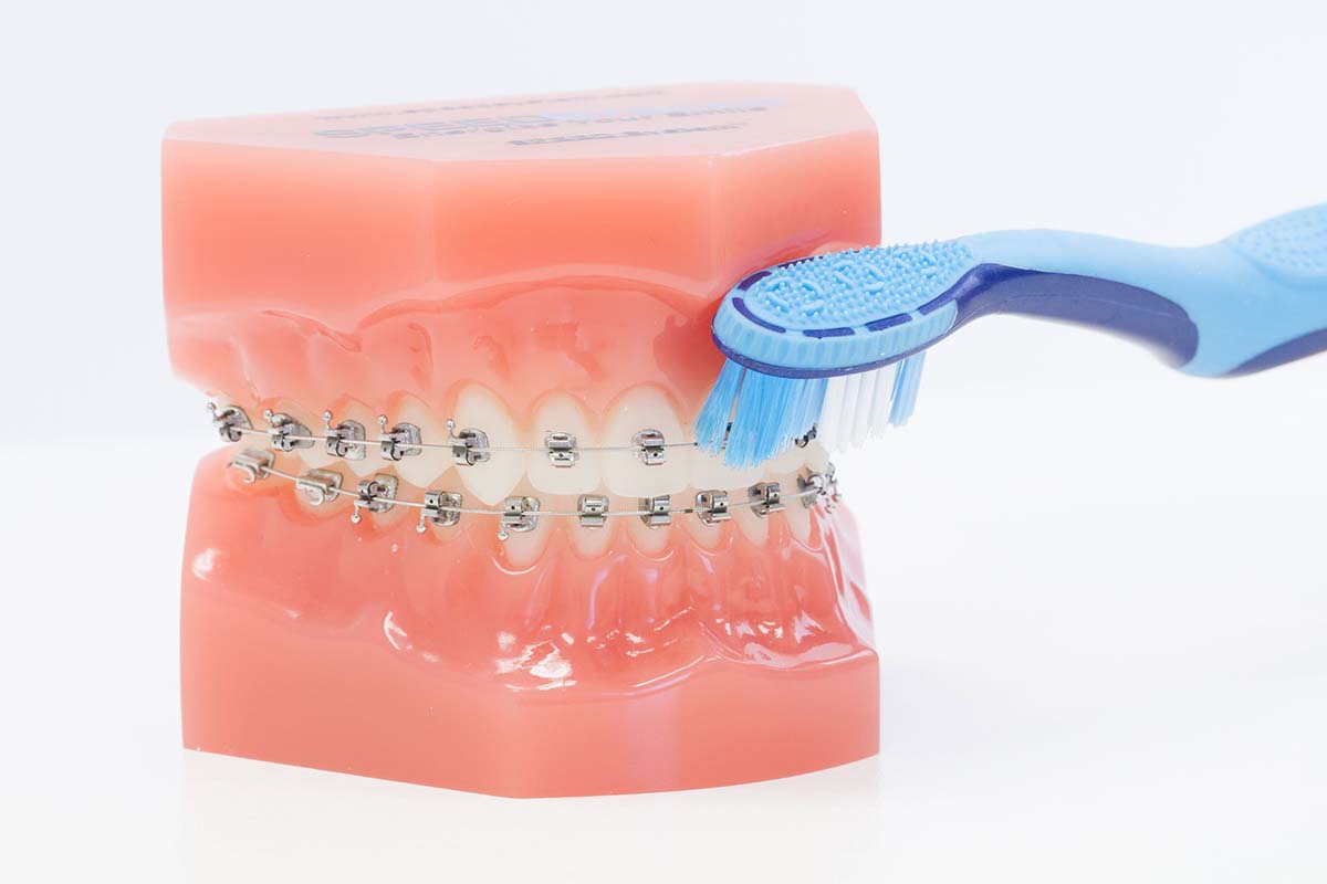 Get Straight Teeth Faster! SPEED Braces at Marda Loop Braces in Calgary