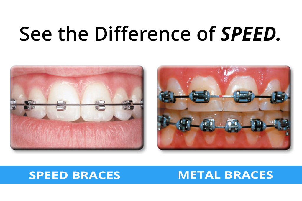 Get Straight Teeth Faster! SPEED Braces at Marda Loop Braces in Calgary
