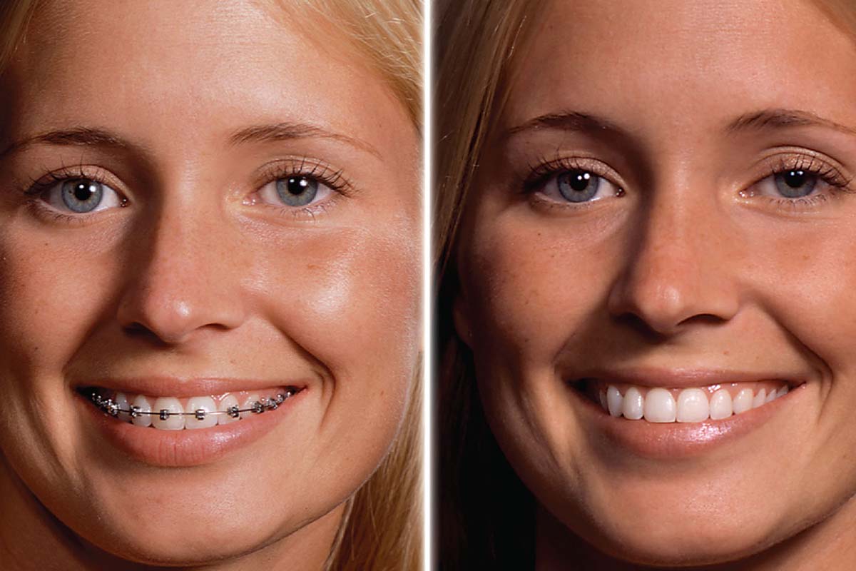 Get Straight Teeth Faster! SPEED Braces at Marda Loop Braces in Calgary