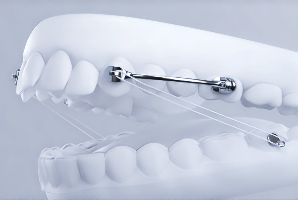 Carriere Motion Experts: Choose Marda Loop Braces for Calgary's Best Smiles