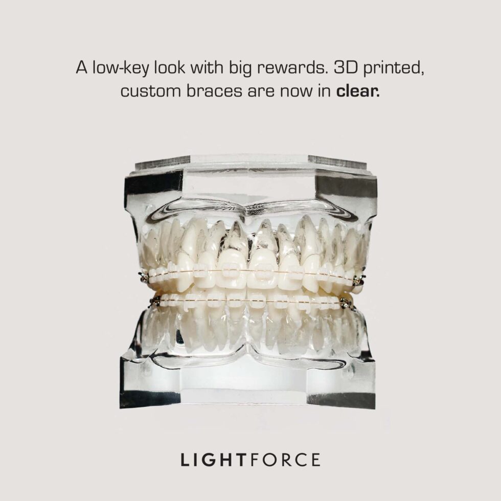 Calgary's Brightest Smiles: LightForce Clear Braces at Marda Loop Braces