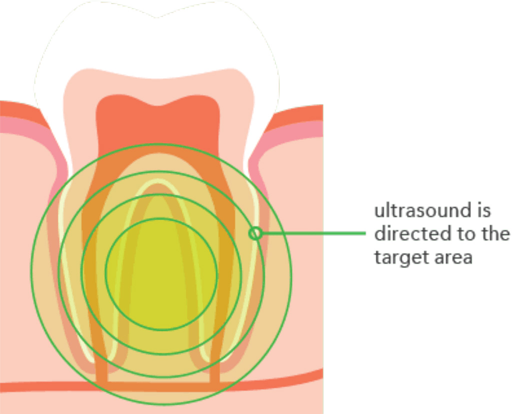 Get a Head Start on Smile Progress: Aevo at Marda Loop Braces
