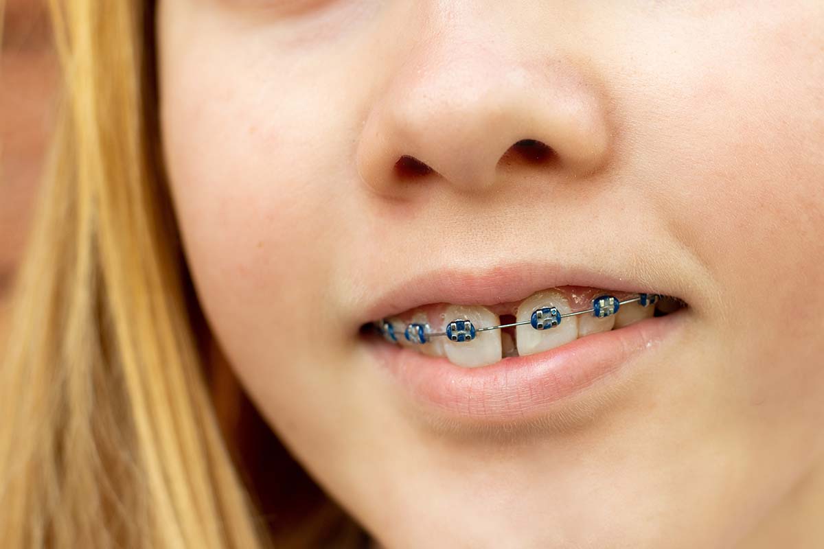 Common Orthodontic Problems | Marda Loop Braces | Calgary, AB